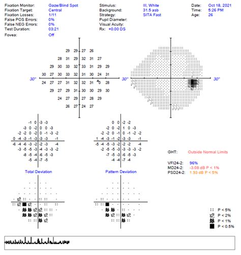 Optic Disc Drusen And Associated Complicationsa Teaching Case Report
