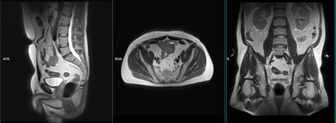 Mri Prostate Protocols Mri Prostate Cancer Multiparametric Planning