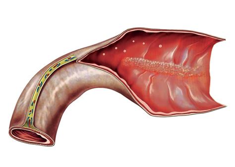 Terminal Ileum