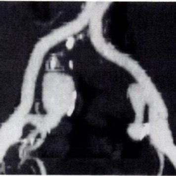 PDF Helical CT Principles And Technical Considerations