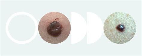 Nodular Melanoma Images Symptoms And Survival Rates Nodular Melanoma Images Symptoms And Survival Rates