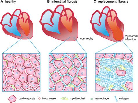 Myocardial Fibrosis A Healthy Myocardium Consists Of A Compact Download Scientific Diagram
