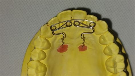 Orthodontic Wire Bending At Catherine Dorsey Blog