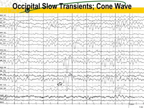 Positive Occipital Sharp Transients Of Sleep Posterior Slow Wave