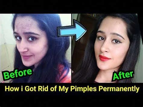 How To Remove Pimples Acne Pimple Marks Completely ThatGlamGirl YouTube How To Remove