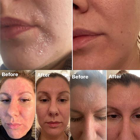 Eczema Skincare Routine And Products To Use To Help Soothe And Ease Eczema The Greys Retreat