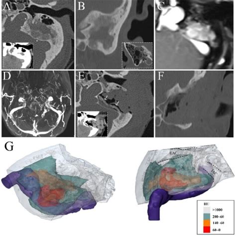 A The High Resolution Temporal Bone Computed Tomography Ct