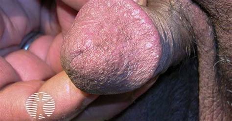 Genital Psoriasis Image