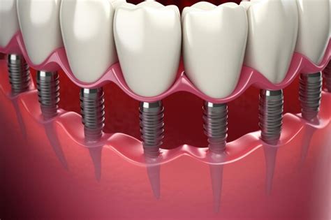 Premium Photo Dental Implant Procedure Restoring Missing Tooth With Mental Model Oral Health
