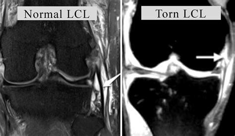 Lcl Treatment In Chennai Lcl Tear Treatment Cost In Chennai
