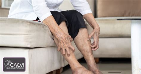 Treatment For Hemosiderin Staining 2025