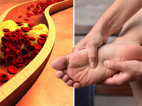 High Cholesterol Levels Symptoms In Men Top 7 Signs Of High Ldl