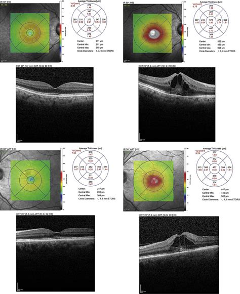 The OCT Scans Of 2 Representative Cataract Patients Who Developed Download Scientific Diagram