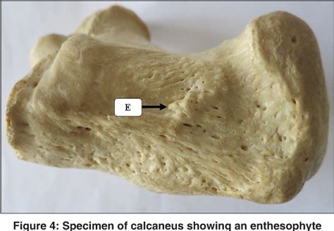 Figure 4 From Enthesophytes And Tubercles Of The Calcaneum An