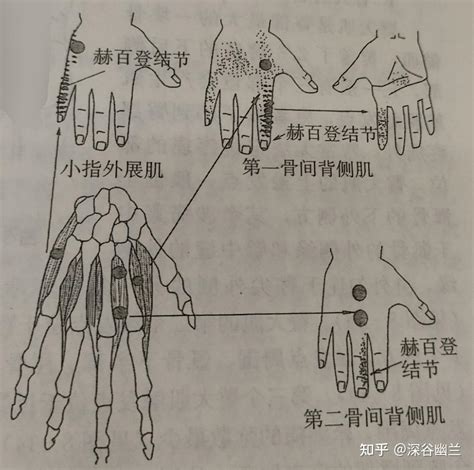 读书笔记骨间背侧肌和小指外展肌触发点 知乎