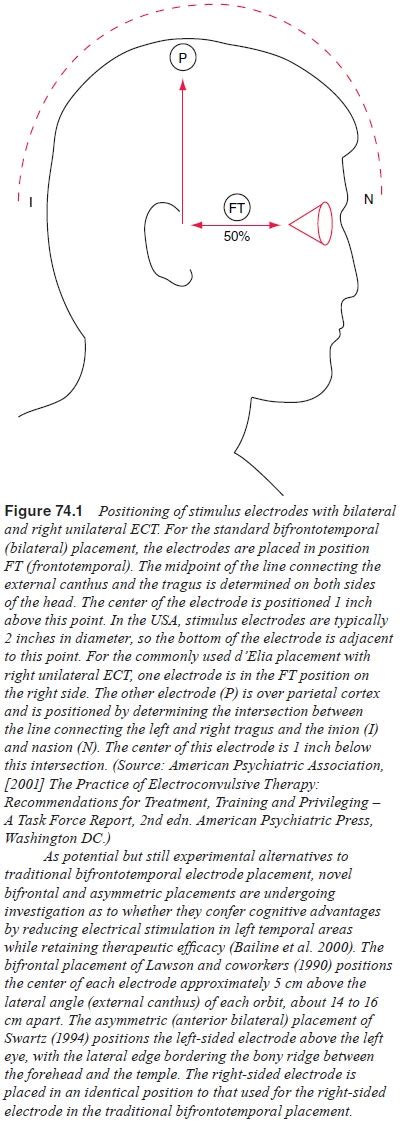 Electroconvulsive Therapyect Treatment