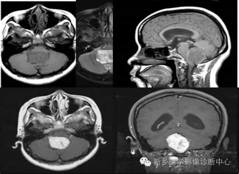 【一文读懂】第四脑室肿瘤的鉴别诊断 信号