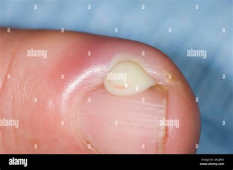 Close Up Of Pus Oozing From A Infection Around The Fingernail In A 57