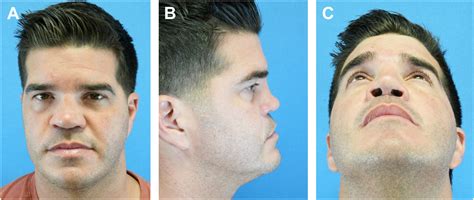 Functional And Cosmetic Considerations In Saddle Nose Deformity Repair