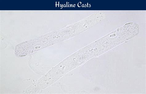 Hyaline Casts In Urine Morphology And Clinical Significance