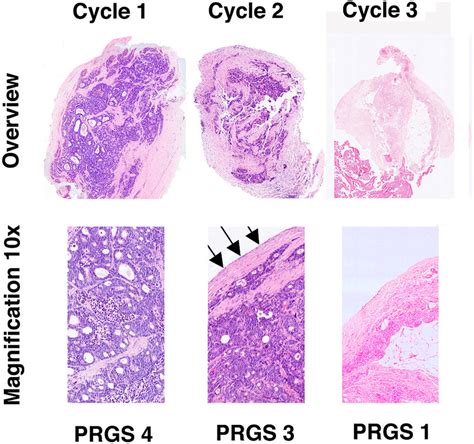 Example Of Histological Regression Under Palliative Chemotherapy