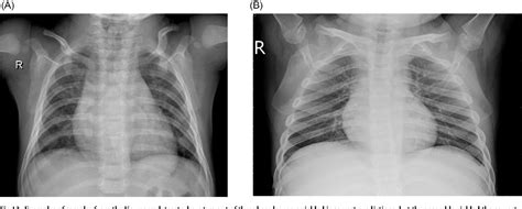 Table 10 From Pneumonia Detection In Chest X Ray Images Using An Ensemble Of Deep Learning
