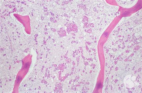 Scc In Bone Marrow 4