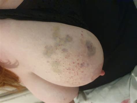 Mrs Kinks Bruised Tits 11 Pics Xhamster