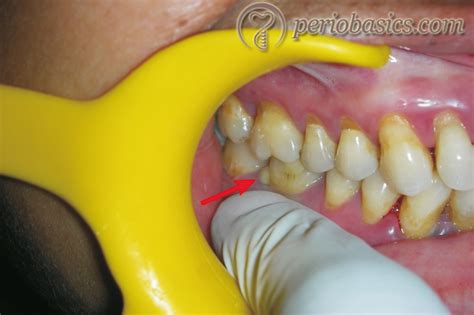 Periodontal Abscess And Its Treatment