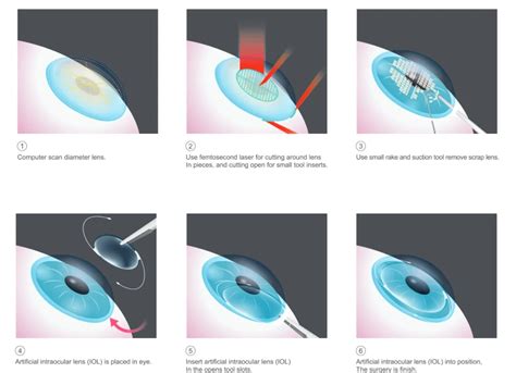 Laser Cataract Surgery London Femto Laser Surgery Low Cost