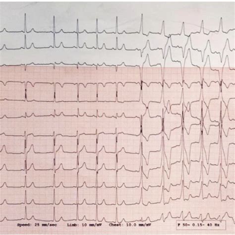 Atrial Tachycardia Atrial Flutter Being Unmasked By Adenosine The Download Scientific Diagram