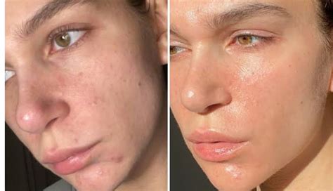 Glov Beauty Micro Infusion Does It Work Infoquu