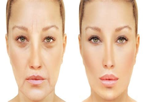 مزوتراپی زیر چشم بهترین روش درمان گودی و سیاهی دور چشم