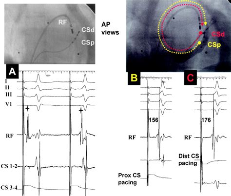 Technique And Results Of Linear Ablation At The Mitral Isthmus Circulation