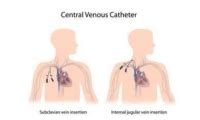 Central Venous Access What Is The Difference Between The Central Venous Catheter CVC And