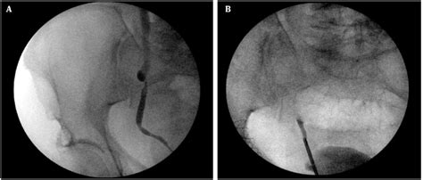 A Retrograde Pyelogram Showing An Area Of Narrowing In The Mid Distal Download Scientific