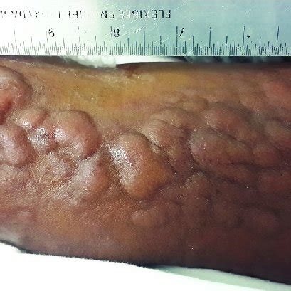 Higher Magnifi Cation Of Skin Nodules Download Scientific Diagram