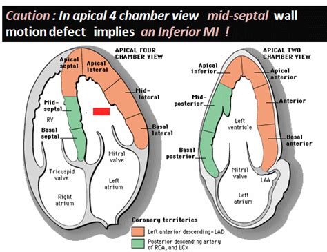Wall Motion Defect Cardiology Arteries Anatomy Cardiac Sonography