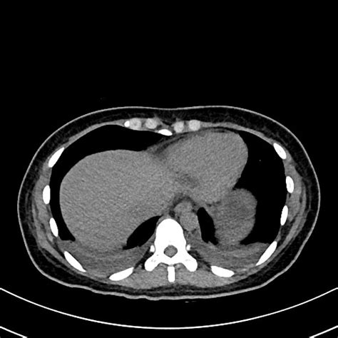 Choledocholithiasis And Choledochal Cyst Radiopaedia 79452 92568 Axial