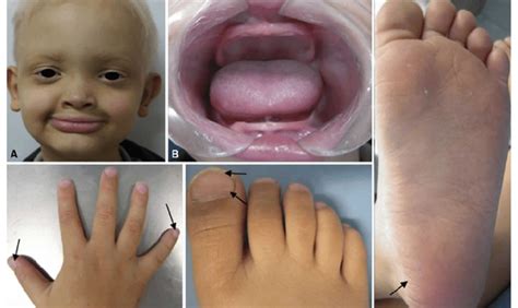 Ectodermal Dysplasia Syndrome Related Healthjournals Ectodermal