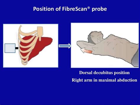 Liver Stiffness Measurement Fibroscan®