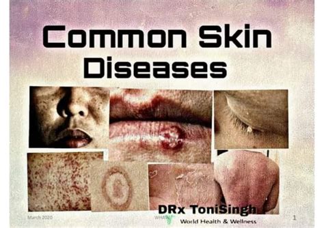 Most Common Skin Diseases Drxtonisingh Pdf