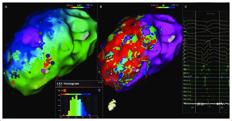 Local Activation Time Mapping Download Scientific Diagram