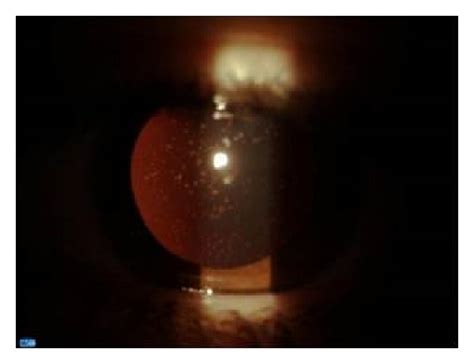 Progression Of Cataract In The Left Eye Of The Patient Described In The