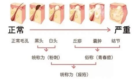 乙酰基二肽 3氨基己酸酯bodyfensine减少皮脂分泌的抗菌多肽 哔哩哔哩