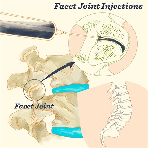 Spinal Facet Injections