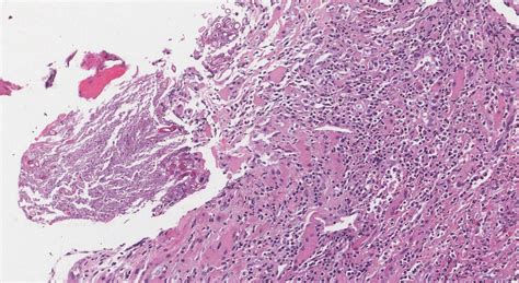 Invasive Fungal Rhinosinusitis Ottawa Atlas Of Pathology