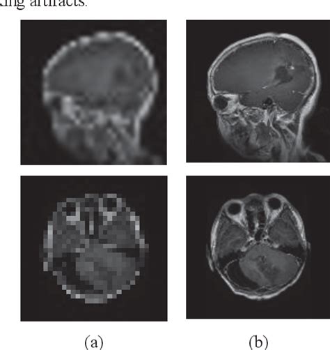 Figure 1 From Enhancing The Resolution Of Brain Mri Images Using Generative Adversarial Networks