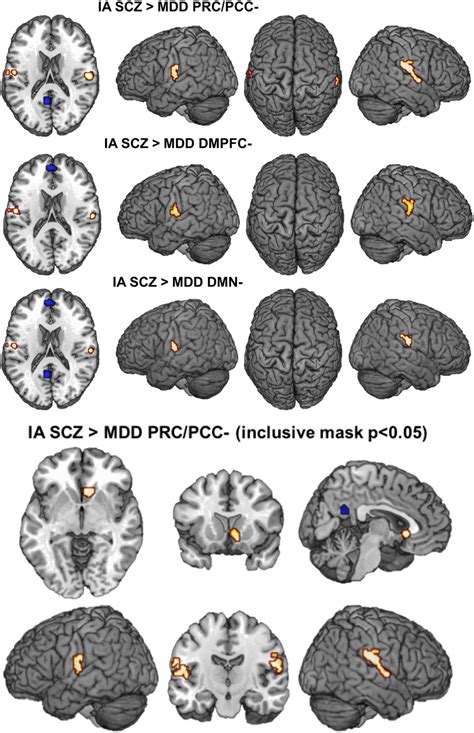 Transdiagnostic Differences In Functional Connectivity Alterations A