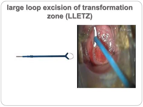 Premalignant And Malignant Conditions Of The Cervix Pptx